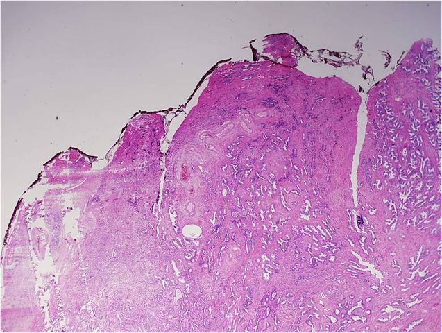 Could Genomics Influence Prostate Cancer Treatment? - American ...