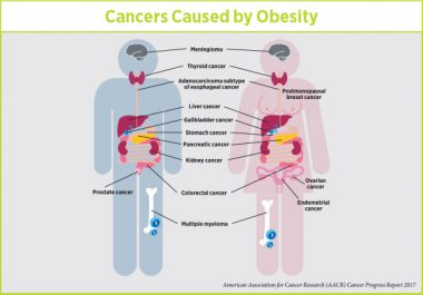 Disrupting a Link Between Obesity and Cancer - American Association for ...