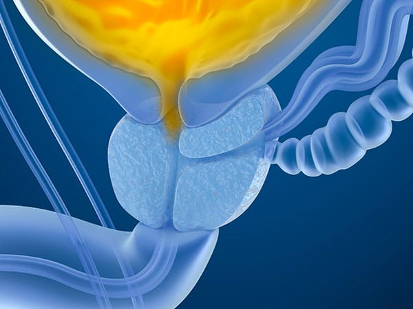 For Prostate Biopsy, It’s Best to Combine Old and New Methods ...