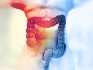 Seeking Clues to Early-onset Colorectal Cancer - American Association ...
