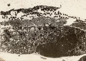 Landmarks in Cancer Research: 1907-1960 | History of the AACR