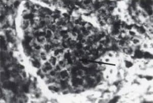 Landmarks in Cancer Research: 1907-1960 | History of the AACR