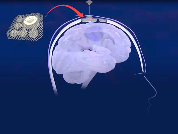Ultrasound Device Opens Blood-brain Barrier - American Association for ...
