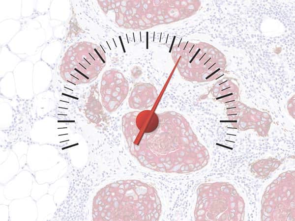 Moving the Needle on Metastatic Breast Cancer - American Association ...