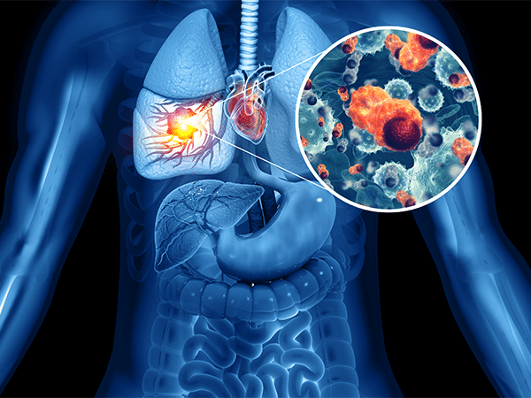 Combination Targeted Therapy for Metastatic Lung Cancer | AACR