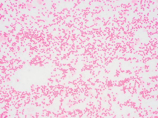 New Targeted Therapy for Myelodysplastic Syndromes | AACR