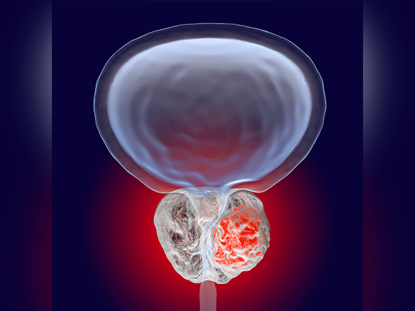 Hormone Therapy for Early-stage Prostate Cancer | AACR