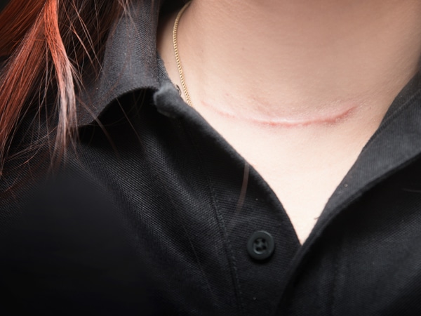 How can I address scars from cancer surgery? - American Association for ...