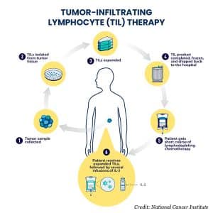 TIL Therapy: A New Melanoma Treatment 30 Years in the Making