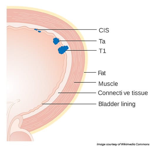 Bladder Cancer: Burgeoning Beyond BCG American Association for Cancer ...