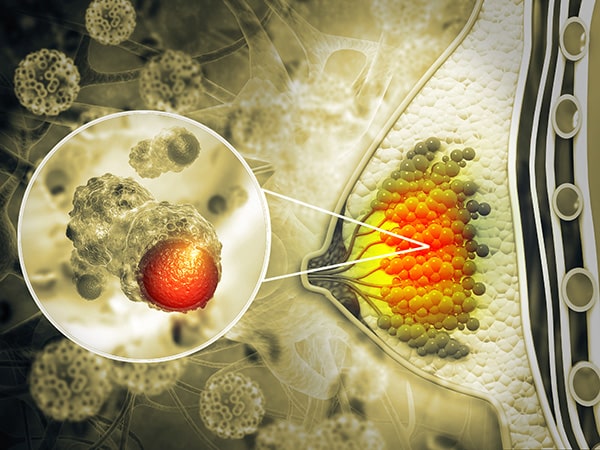 New Combination Therapy for Early-stage Breast Cancers | Research | AACR