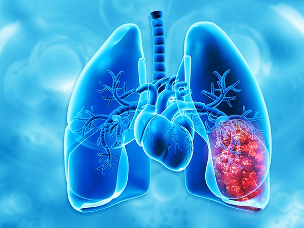 Amivantamab Plus Chemo Approved for Some EGFR-mutated Lung Cancers ...
