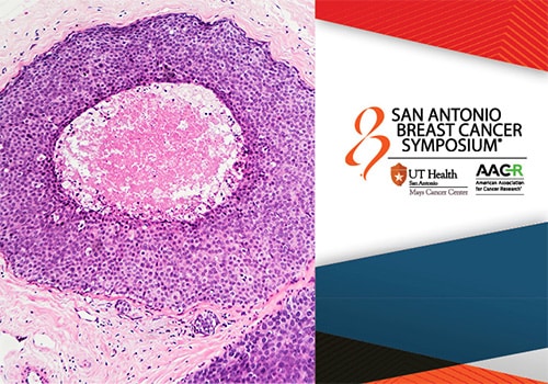 Giving More Options to Patients With DCIS | Blog | AACR