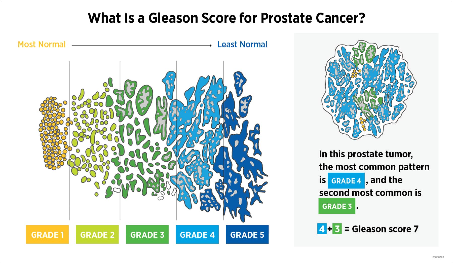 What Is a Gleason Score for Prostate Cancer? | Blog | AACR