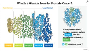 What Is a Gleason Score for Prostate Cancer? | Blog | AACR